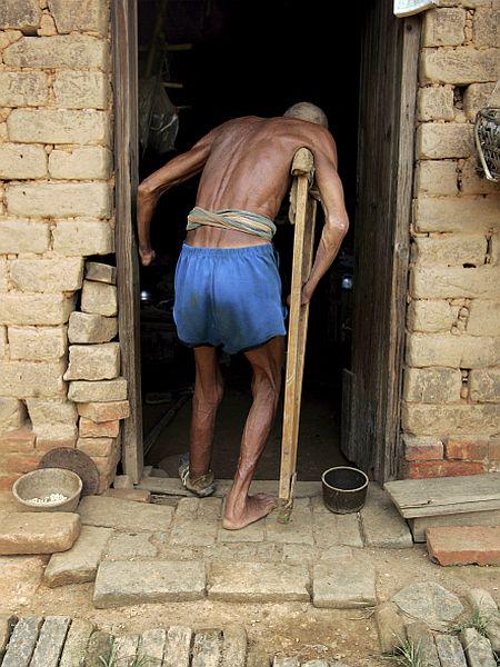 Gobavost še zdaleč ni bolezen preteklosti - RTVSLO.si